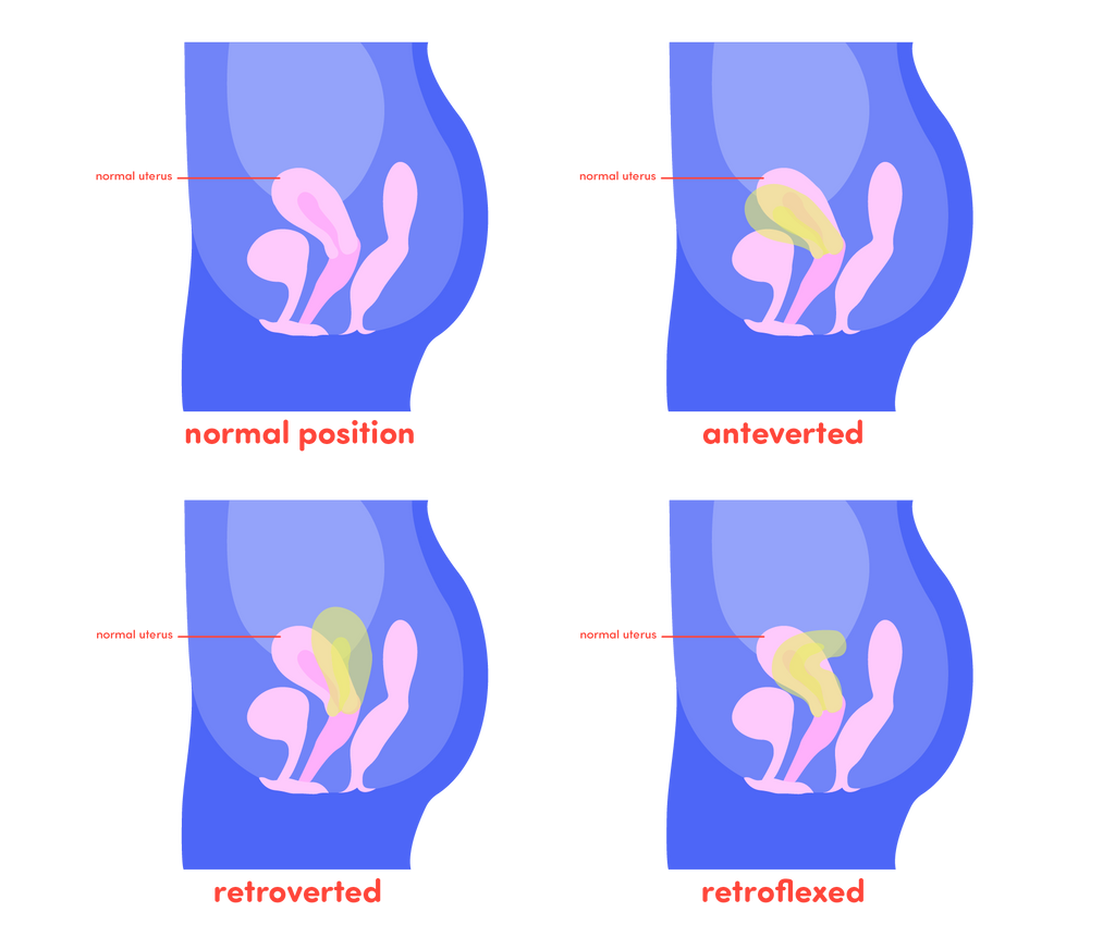 Normal Uterus And Tilted Uterus Best Menstrual Cup For A Tilted Uterus